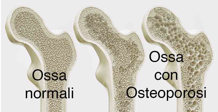 Salute delle Ossa e Osteoporosi, Cosa significa per voi? - saluteinessere